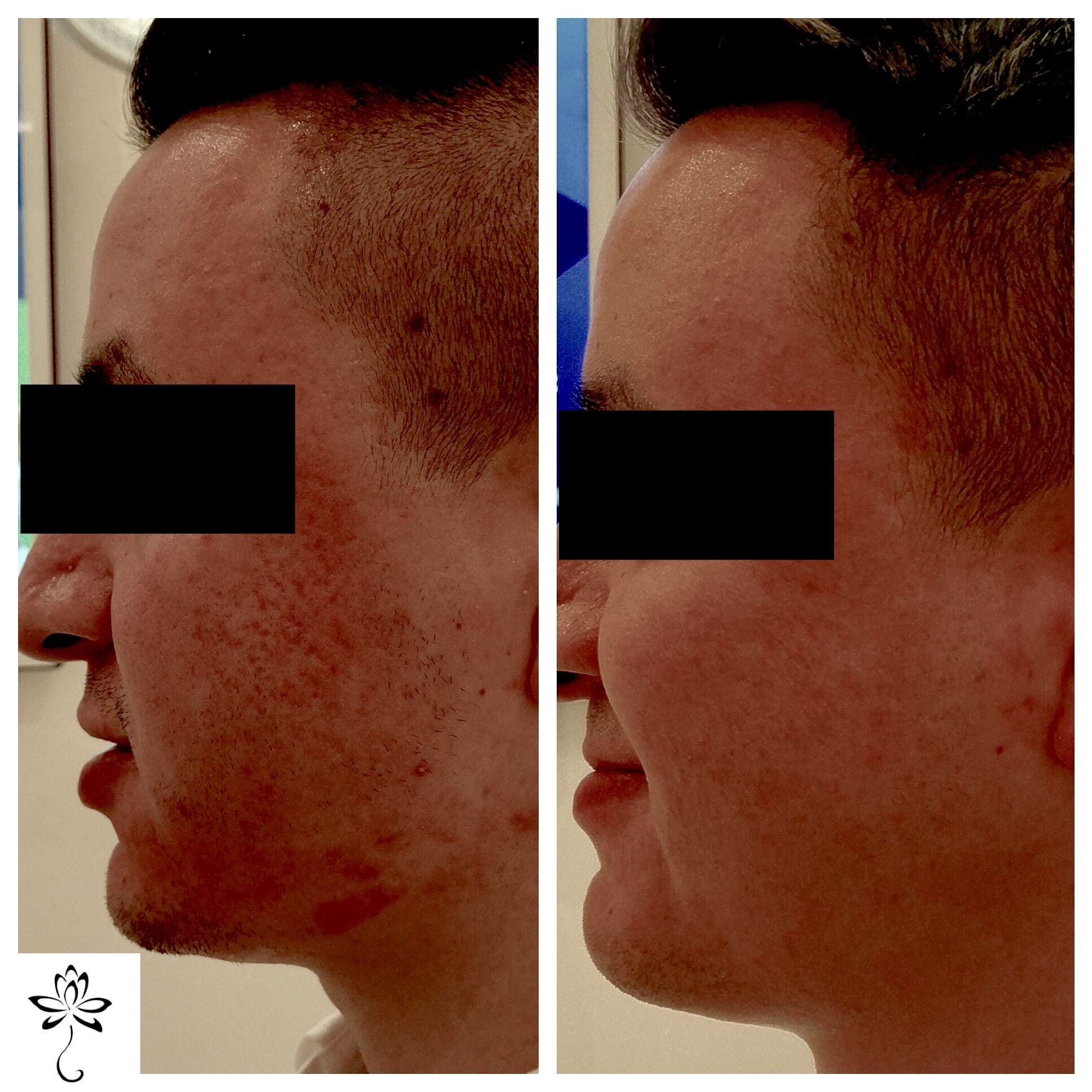 Boxcar Shaped Acne Scar