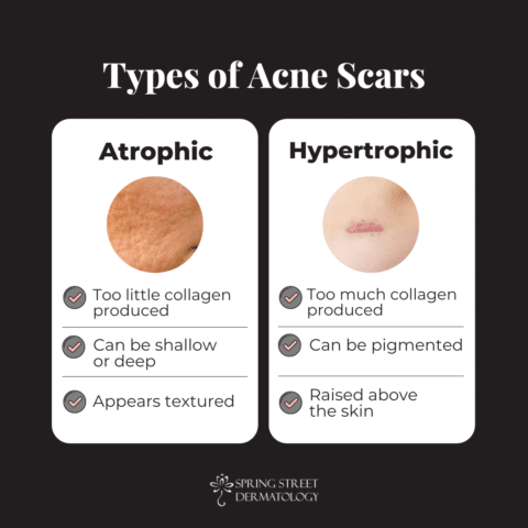 Combating Acne Scars: Effective Medical Solutions - Spring Street ...