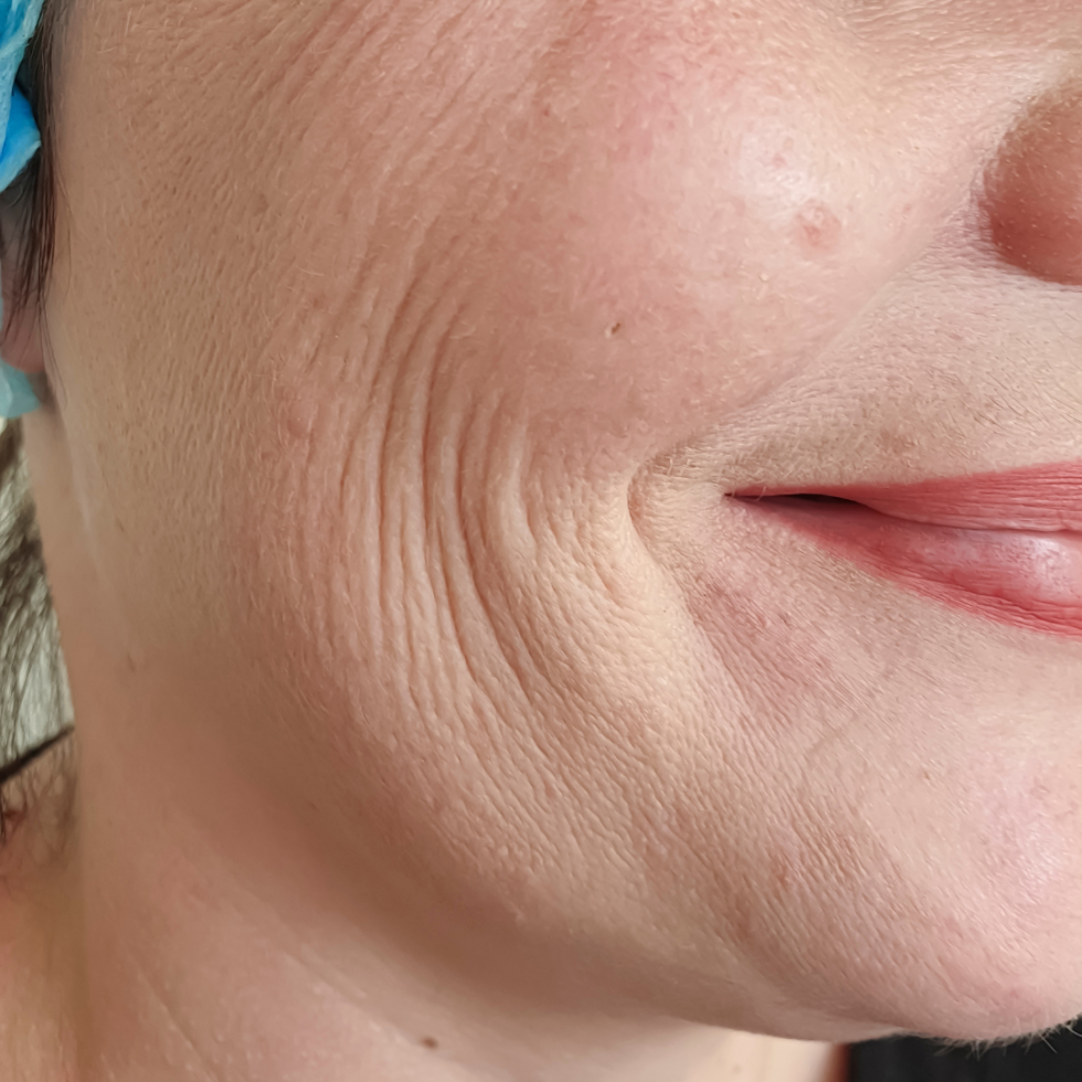 Sofwave Treatment New York, NY | Spring Street Dermatology