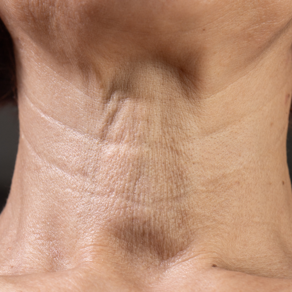 4 Effective Non-Surgical Neck Tightening Procedures To Try in 2025 ...